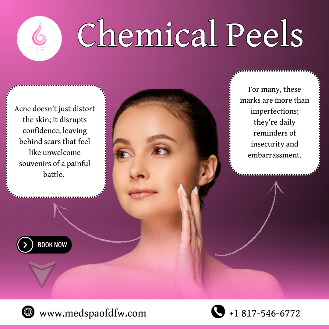 Chemical Peels for Acne Scars in Grapevine/Southlake, TX